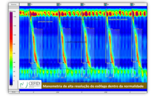 Manometria do esôfago de alta resolução – CEFIDI